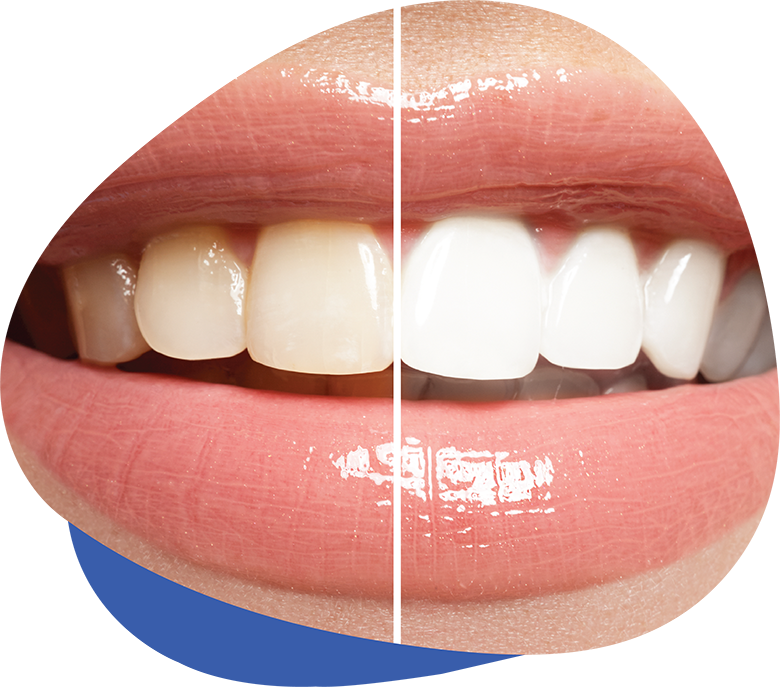 Professional Teeth Whitening at Westerville Dental Associates